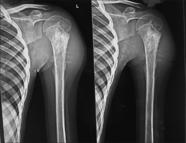 Ewing's sarcoma: Signs, Symptoms, Diagnosis & Treatments